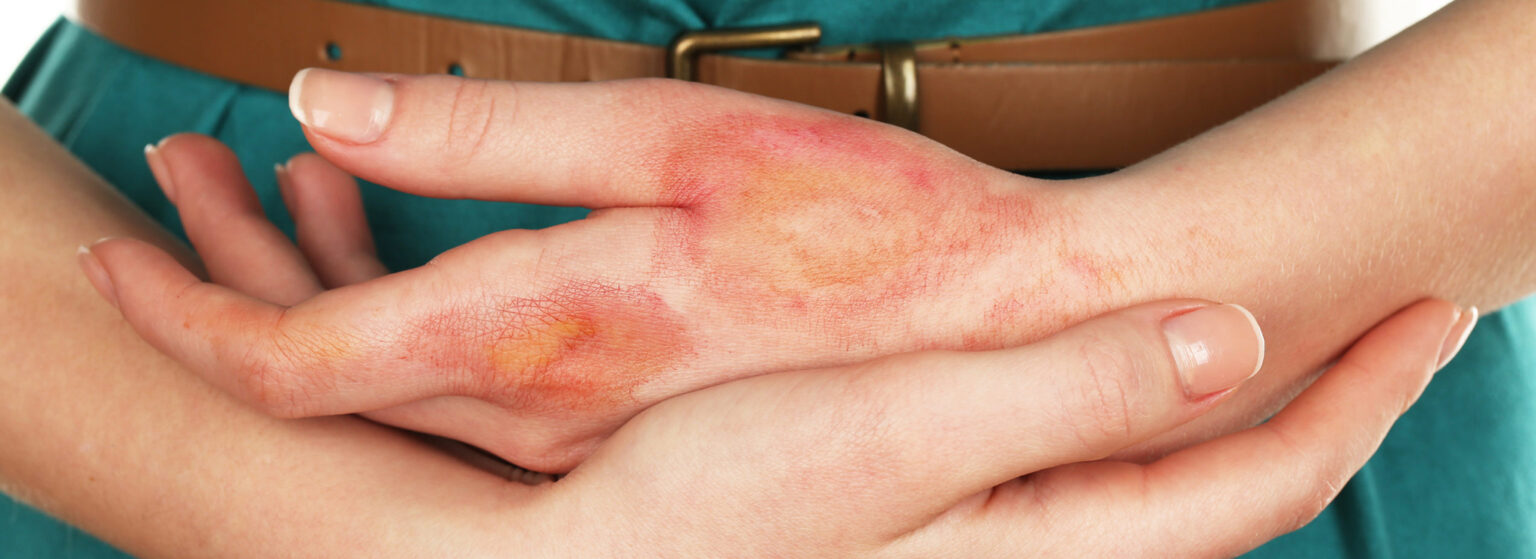 How to Treat a Minor Burn at Home - The Doctors' Office Walk-In Urgent Care