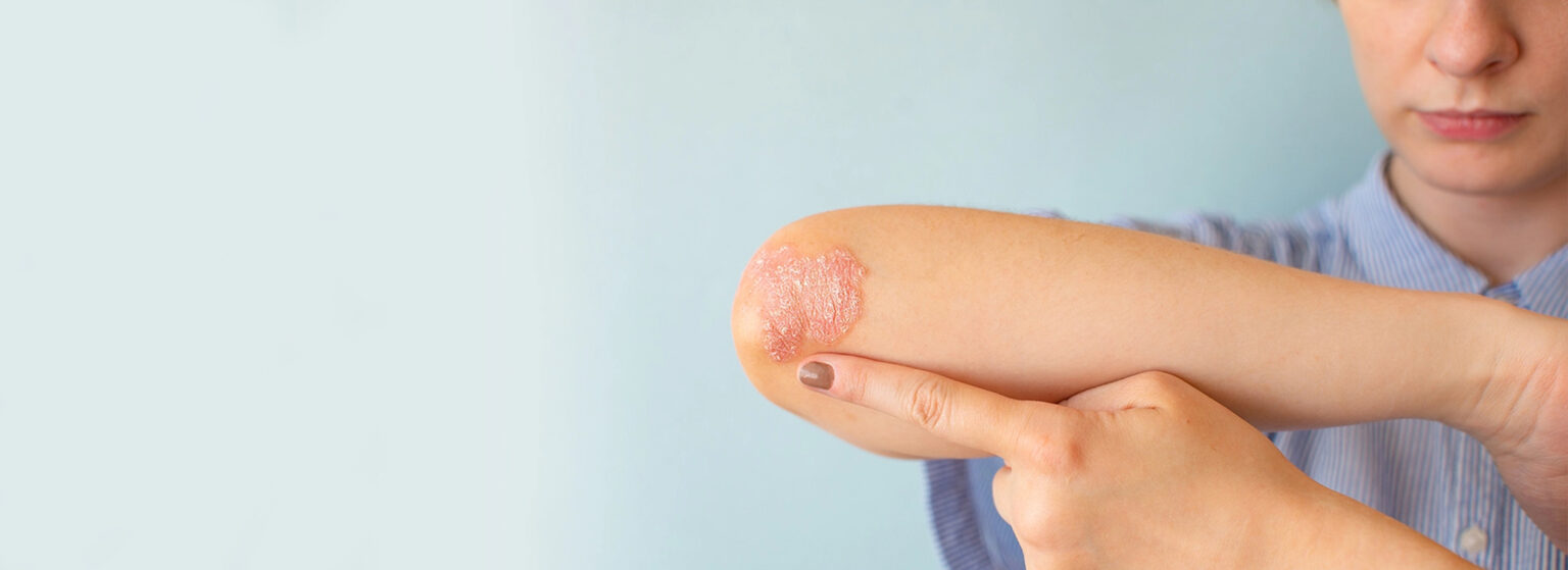 What is Ringworm: Symptoms and Treatment - The Doctors' Office Walk-In ...